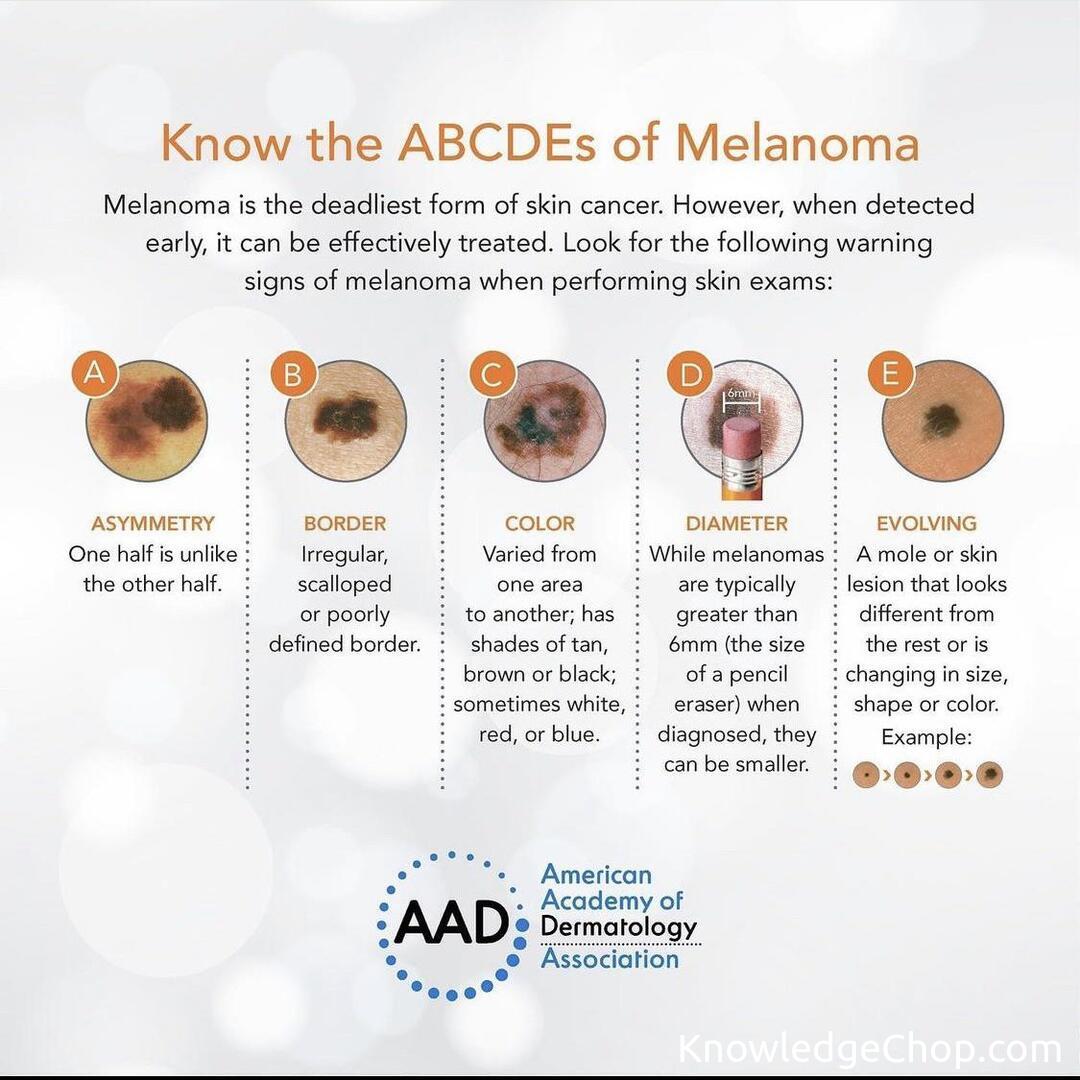 Melanoma guide | 🥷 Knowledge Ninja
