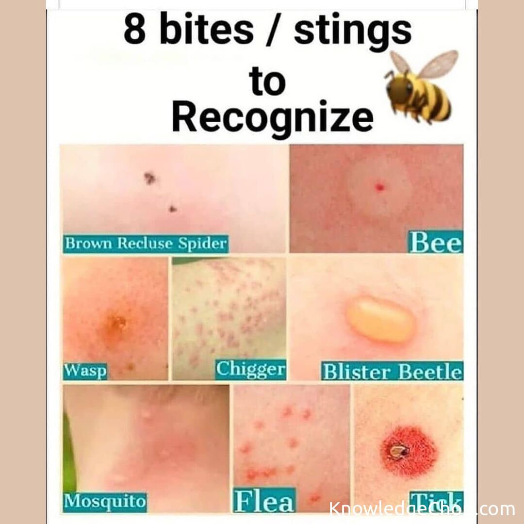 8 Bites stings To Recognize Knowledge Ninja